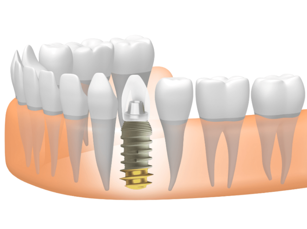 Our Course On Immediate Functional Loading A Game-Changer In Implant ...